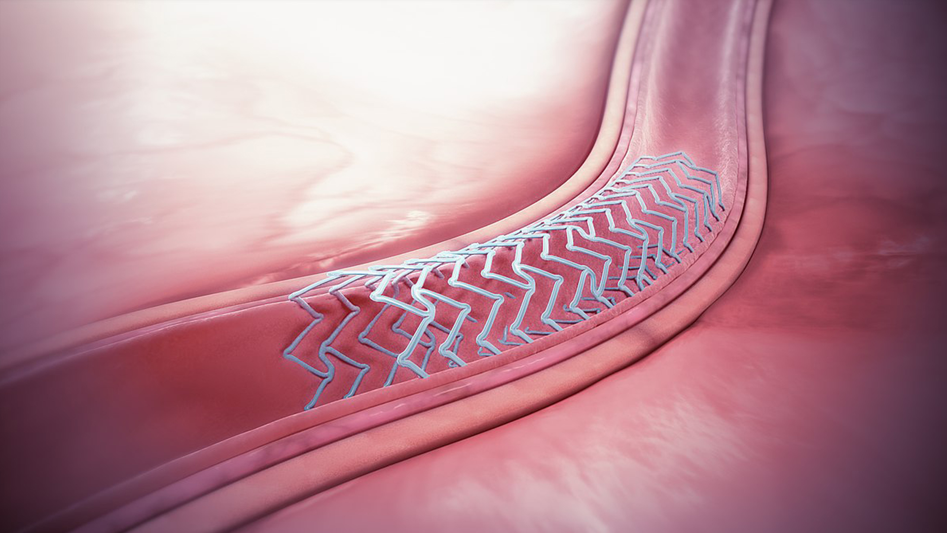 Medica Superspecialty Hospital implemented absorbable stent ...