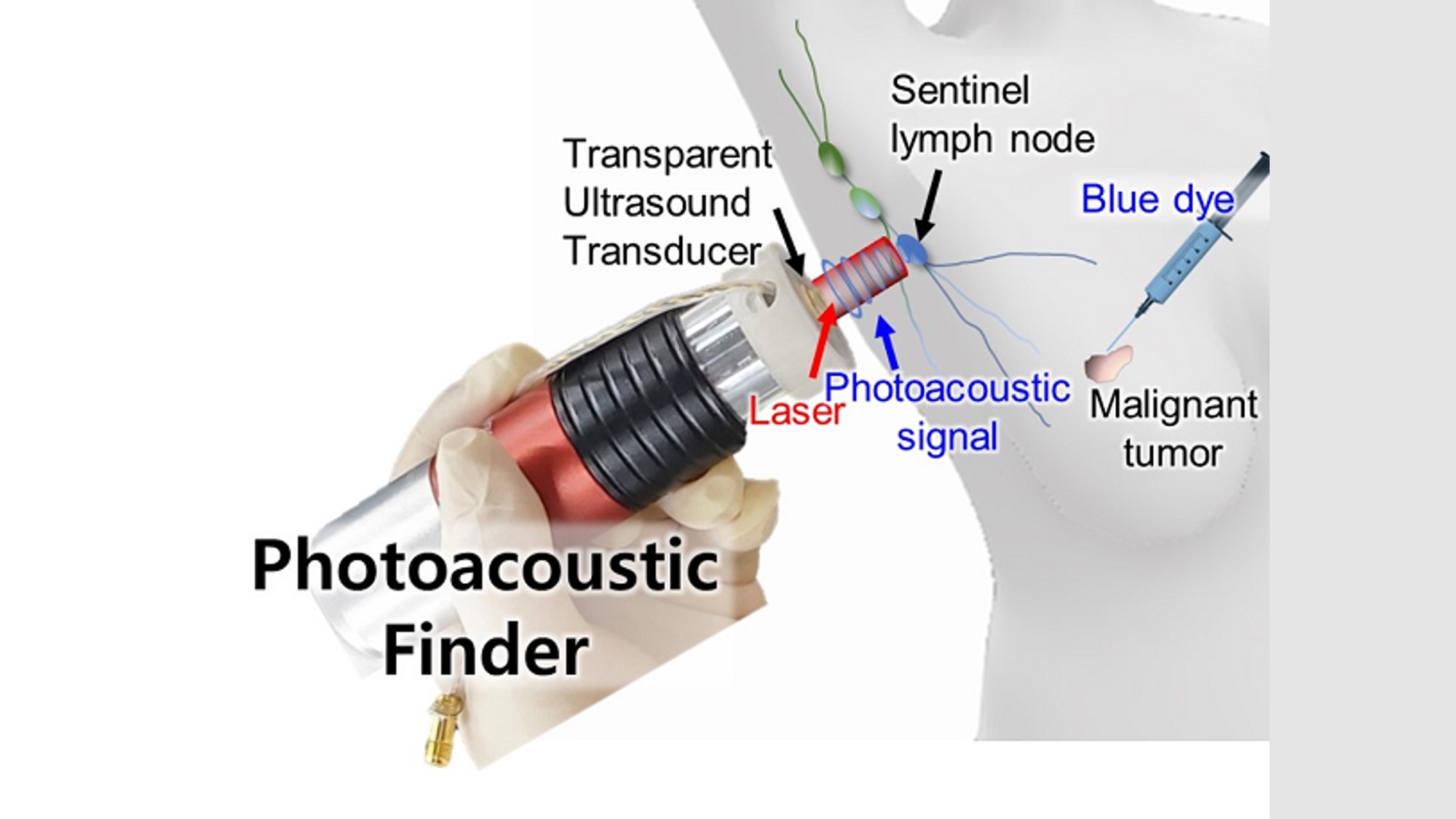 Handheld photoacoustic finder for diagnosing cancer metastasis without ...