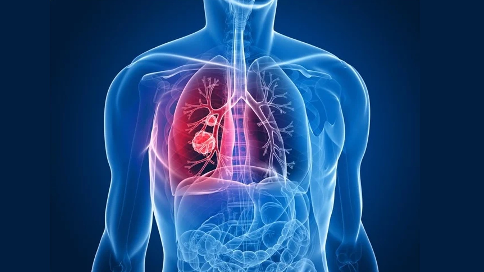 Genomic analysis of lung cancer in never smokers identifies three ...