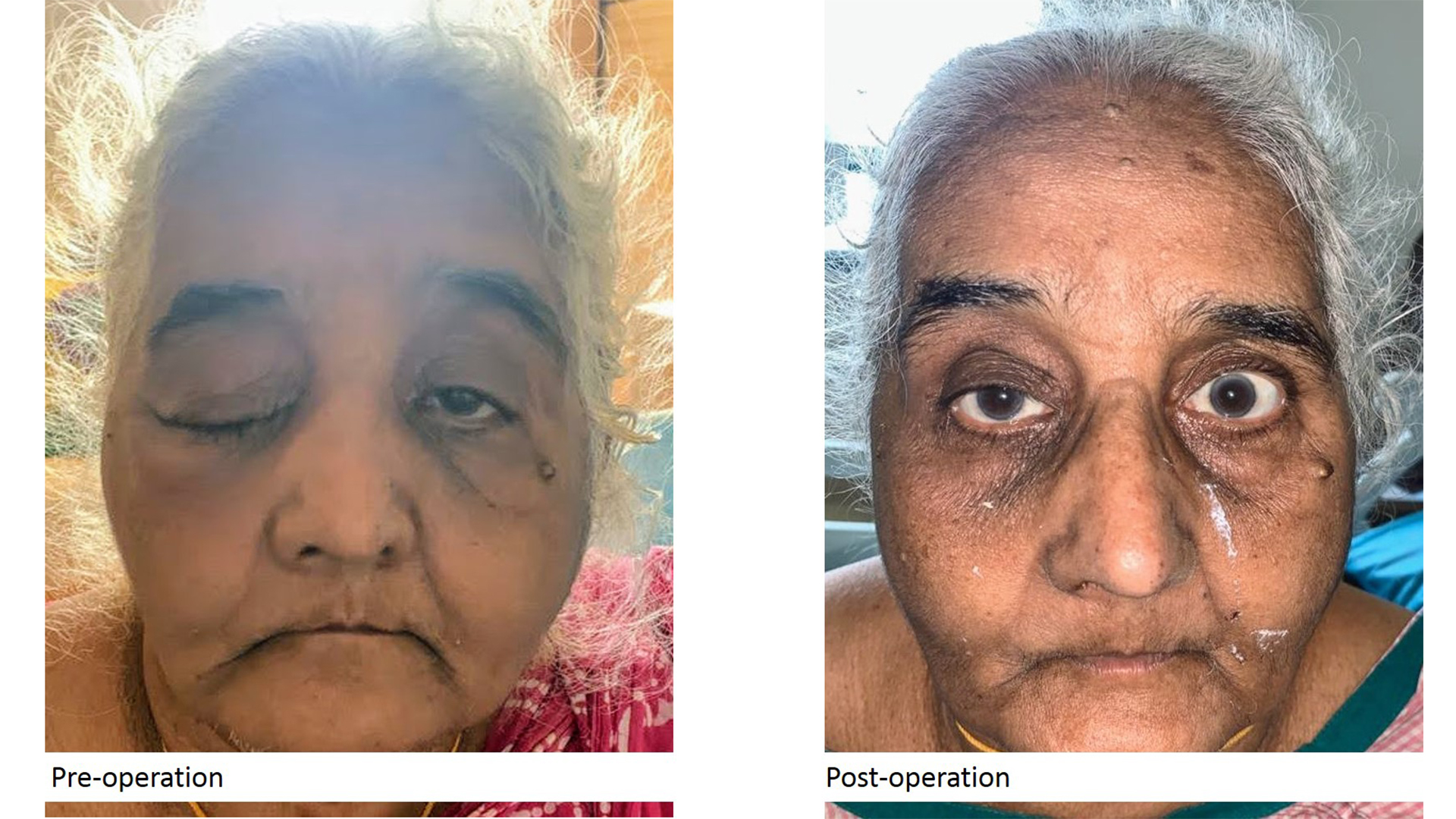 Successful endoscopic transnasal orbital surgery - Healthcare Radius