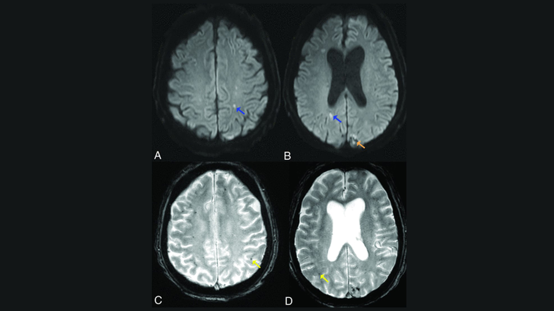 Brain MRI findings could be connected to SARS-CoV-2 in spinal fluid ...