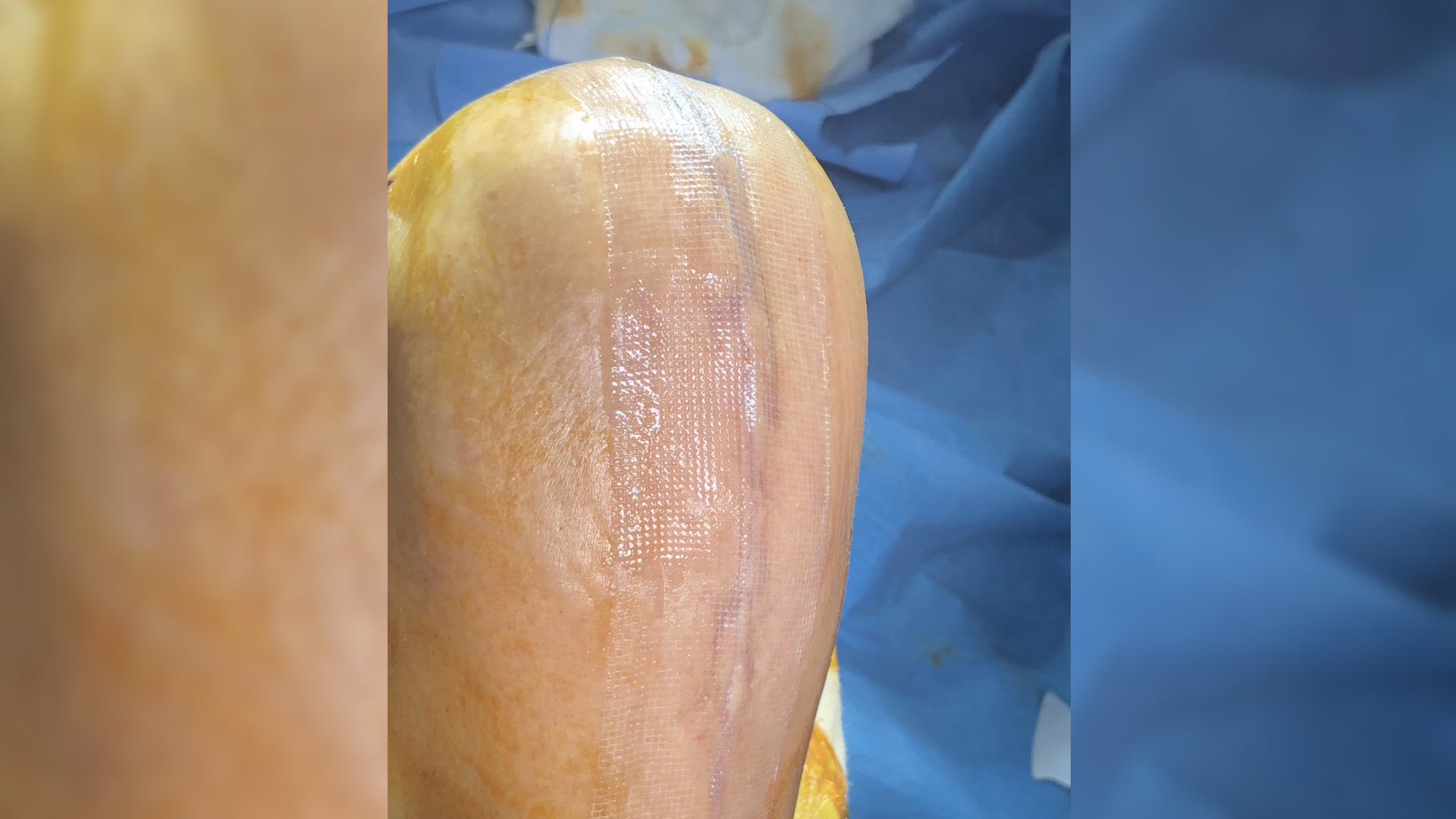 Technological advancements in wound closure management - Healthcare Radius