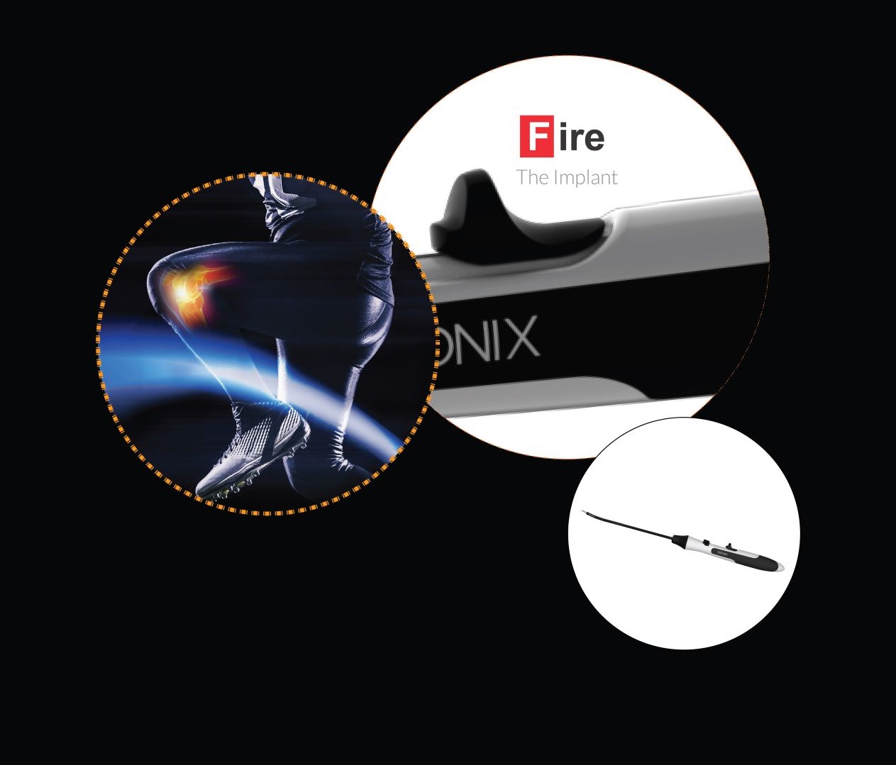 Healthium Medtech launches 'Surestitch’ meniscal repair device ...