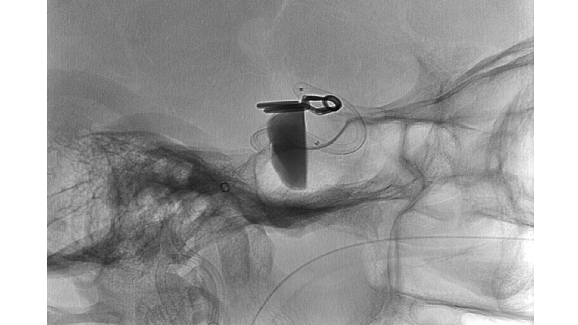 Oman boy undergoes bullet shrapnel removal surgery at Aster Medcity ...