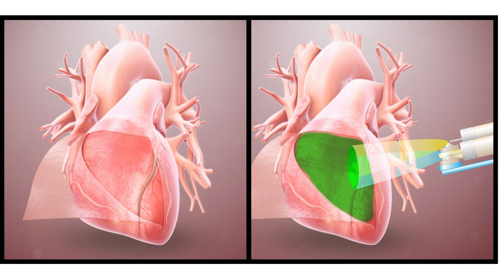Bio-inspired hydrogel protects the heart from post-op adhesions ...