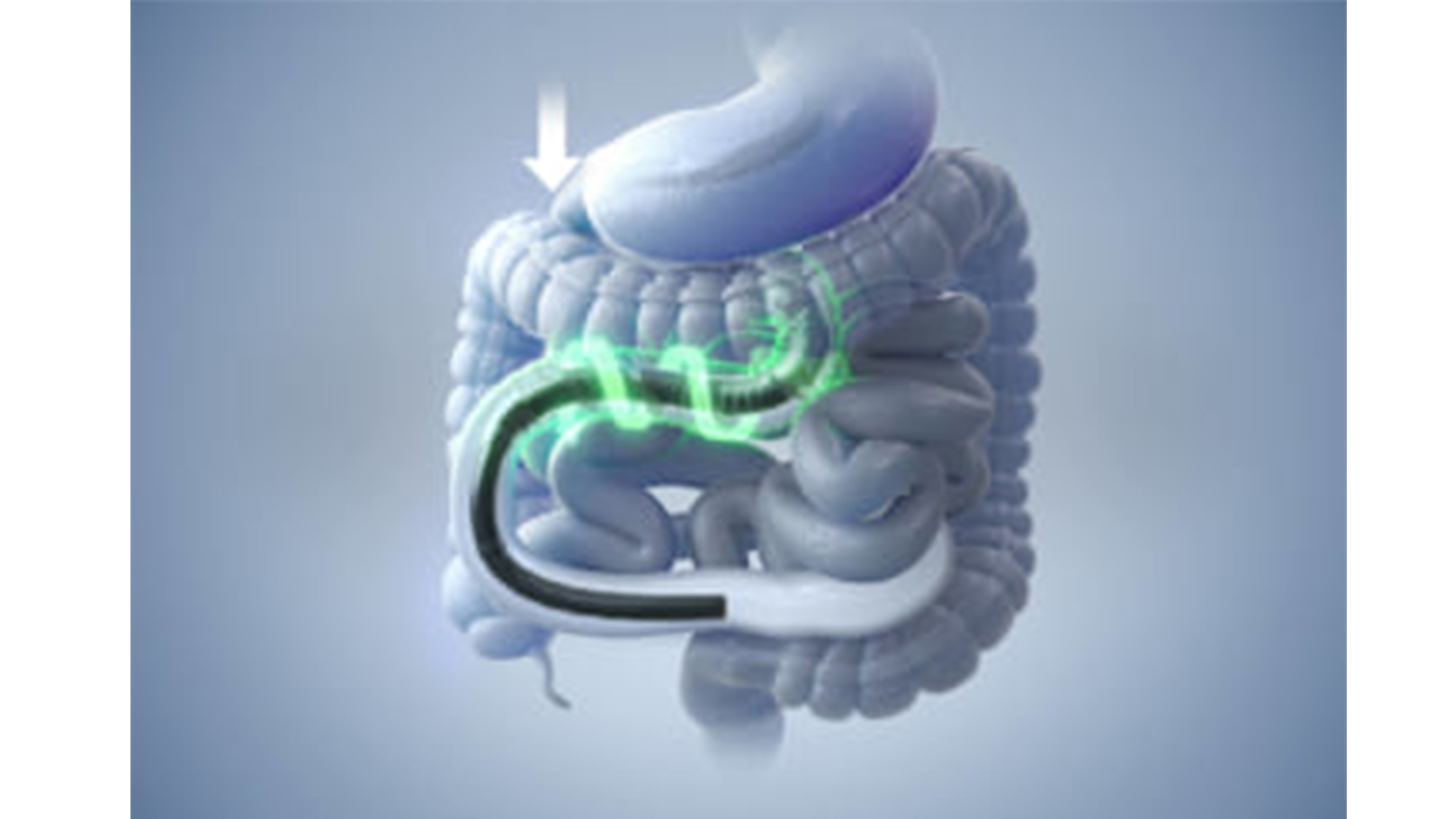 Power Spiral Enteroscopy for a case of Small Intestinal Crohn's Disease ...