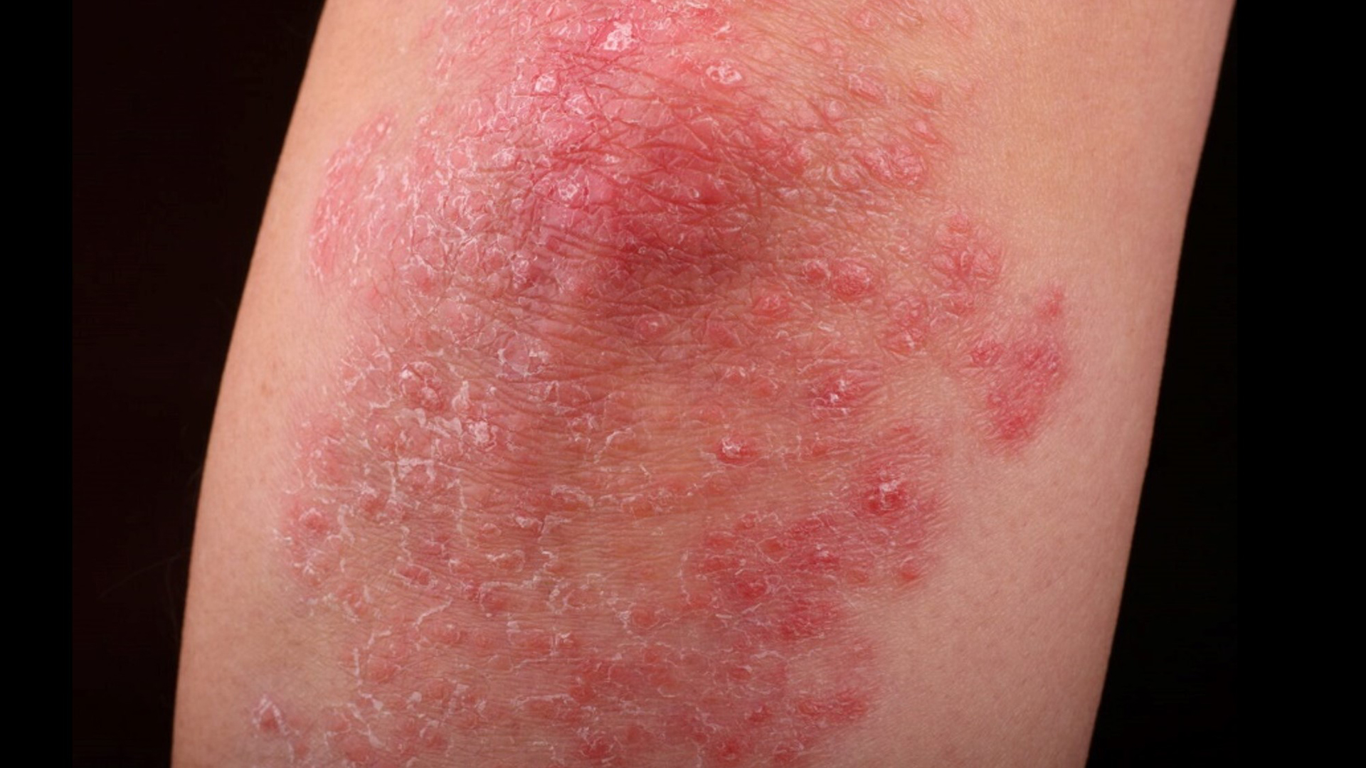 Psoriasis severity is potentially reduced by targeting protein ...