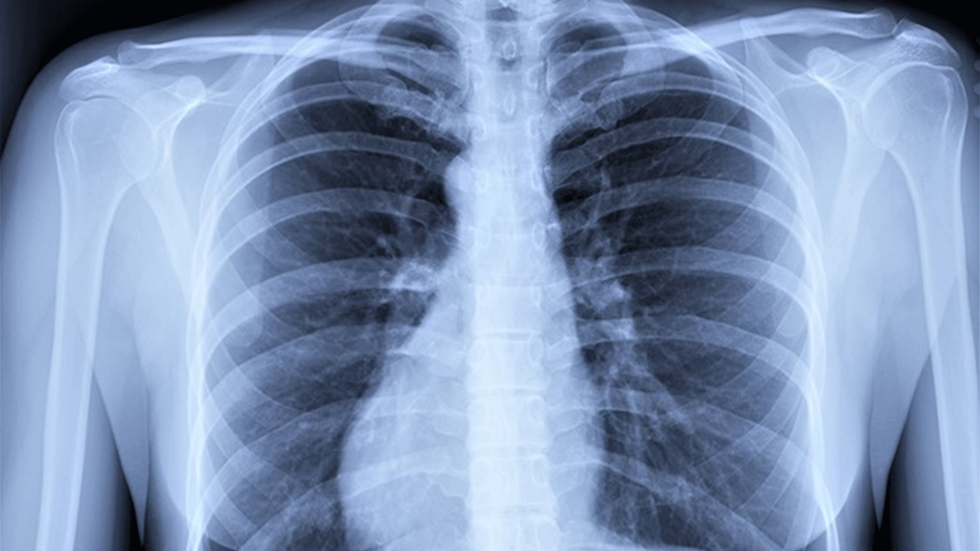 Imaging considerations in COVID-19 patients - Healthcare Radius