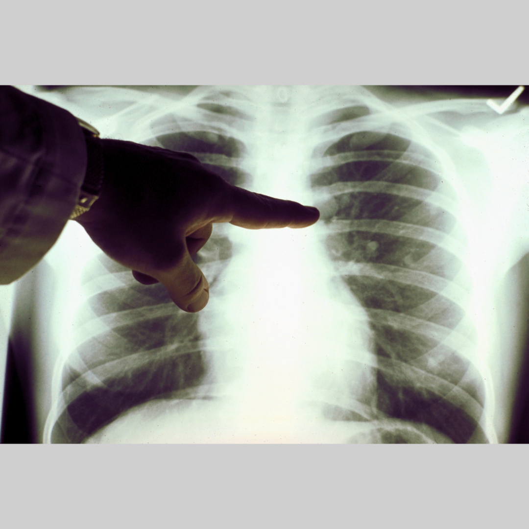 Scientist to develop early detection test for lung cancer - Healthcare ...
