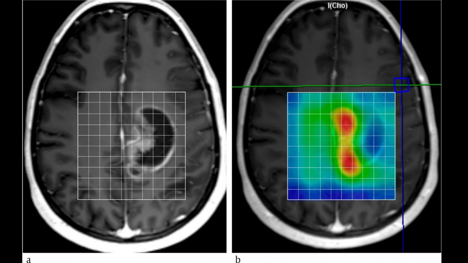 New study suggests MR Spectroscopy may detect brain changes linked to ...