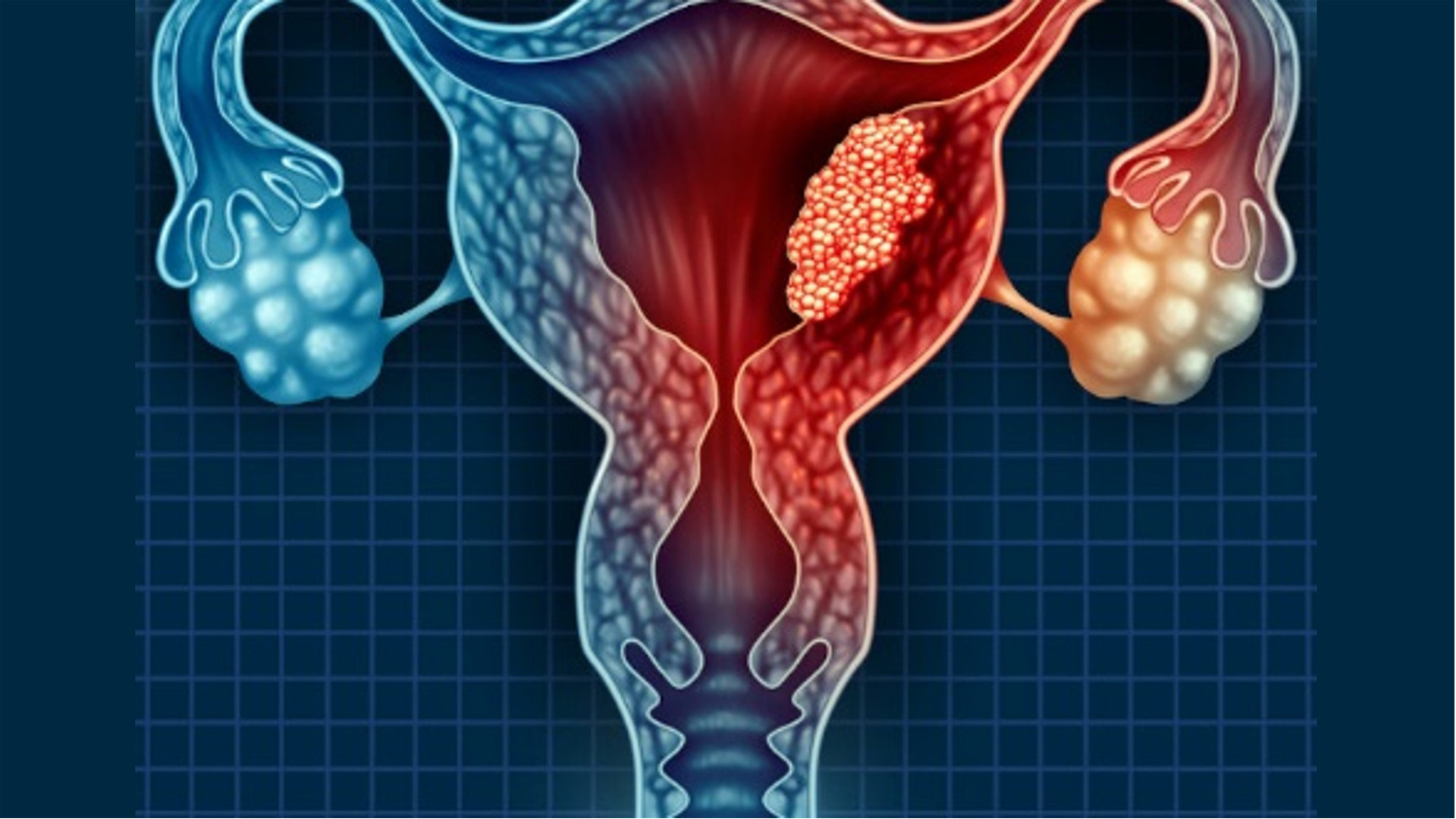 Creating awareness on the increasing burden of cervical cancer in women ...