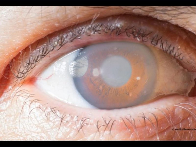 Entod develops eye drops that might eliminate reading glasses ...