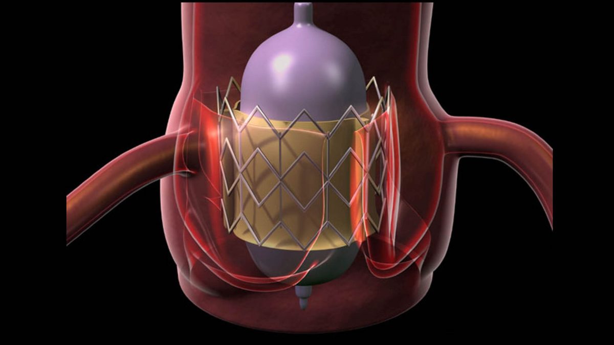 Prashanth Hospital successfully performs TAVR on two septuagenarians ...