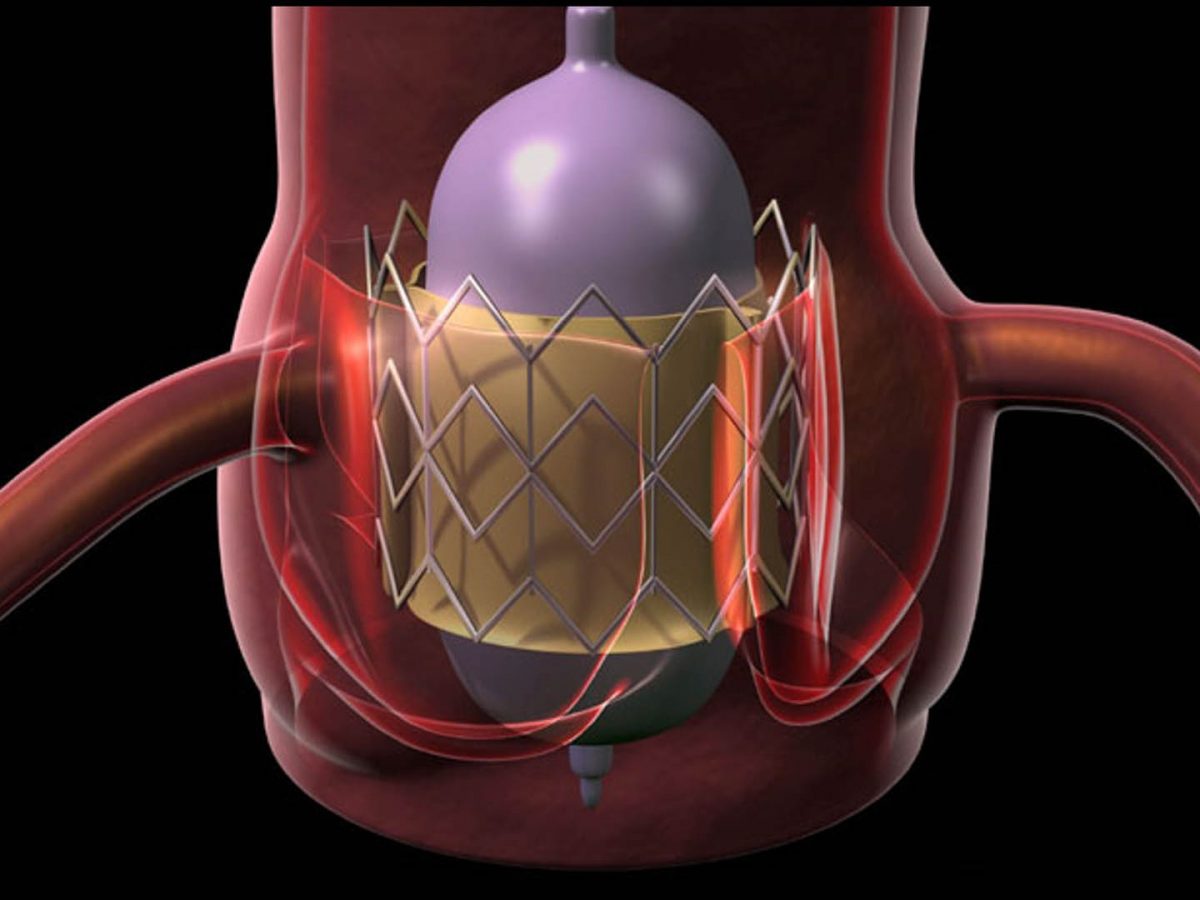 Prashanth Hospital successfully performs TAVR on two septuagenarians ...