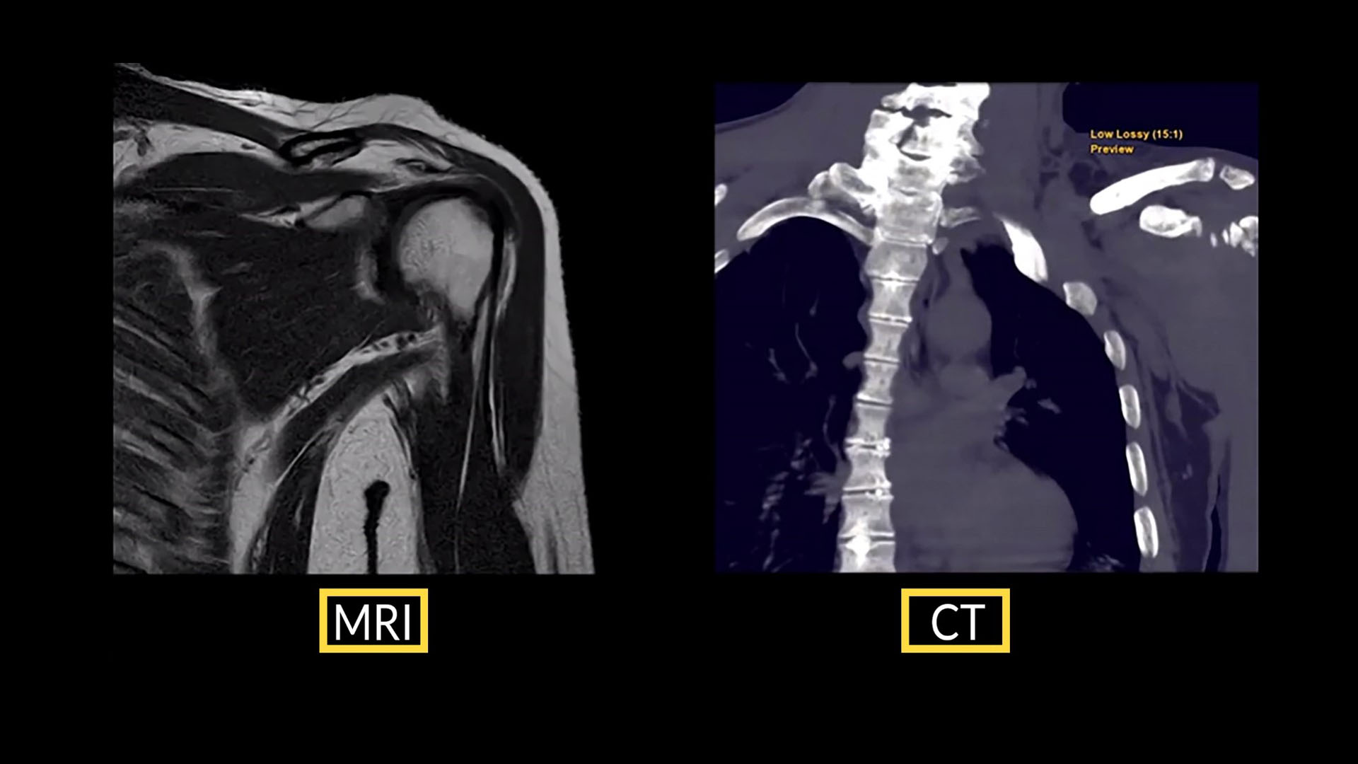 RSIP Vision presents a new tool for Total Shoulder Arthroplasty (TSA ...