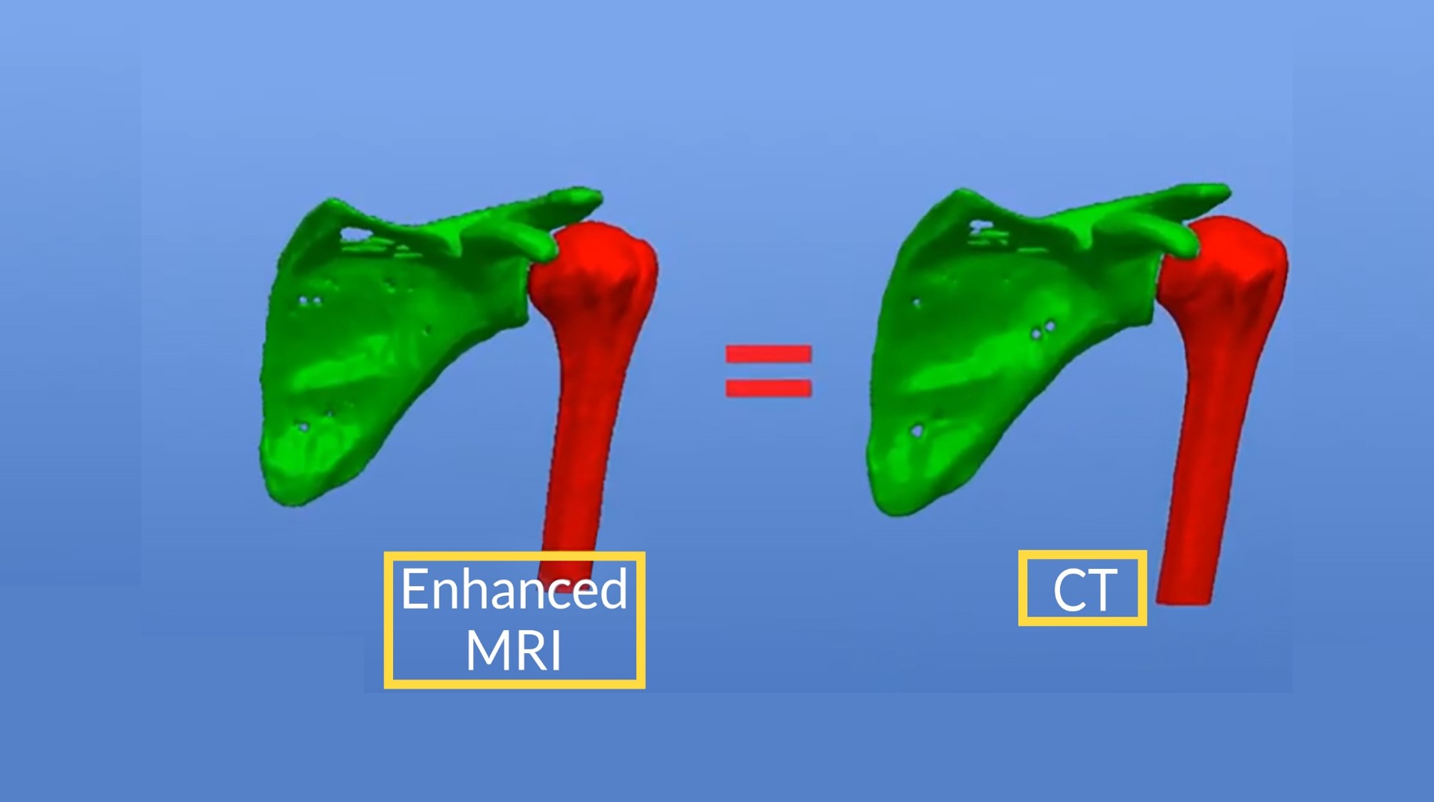 RSIP Vision presents a new tool for Total Shoulder Arthroplasty (TSA ...