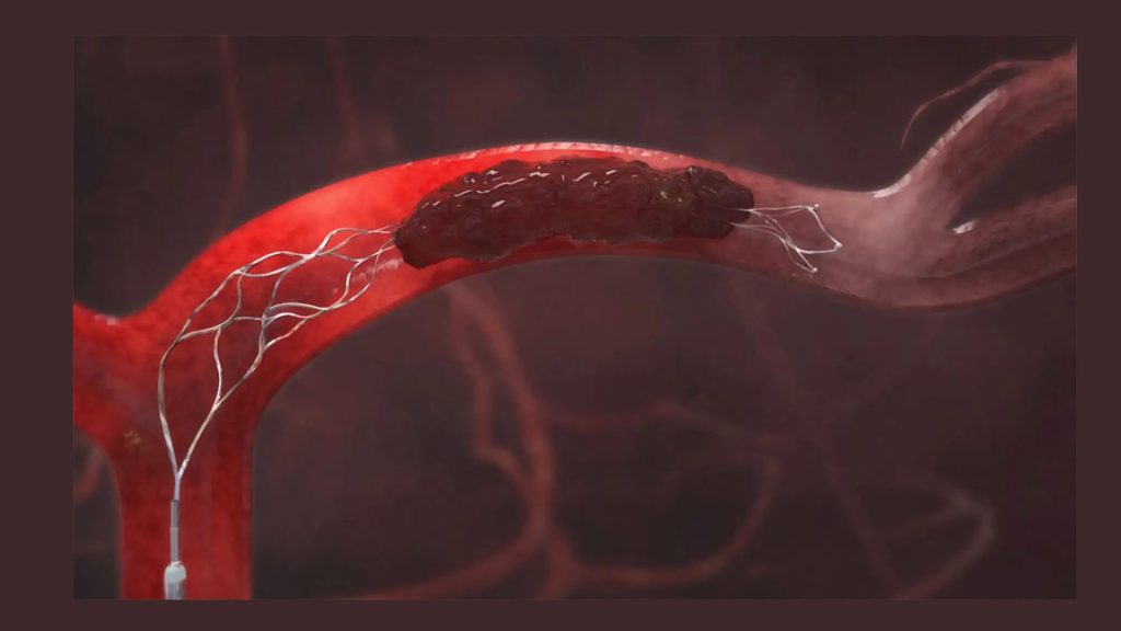 Cardiovascular Systems and Innova Vascular partner on thrombectomy ...