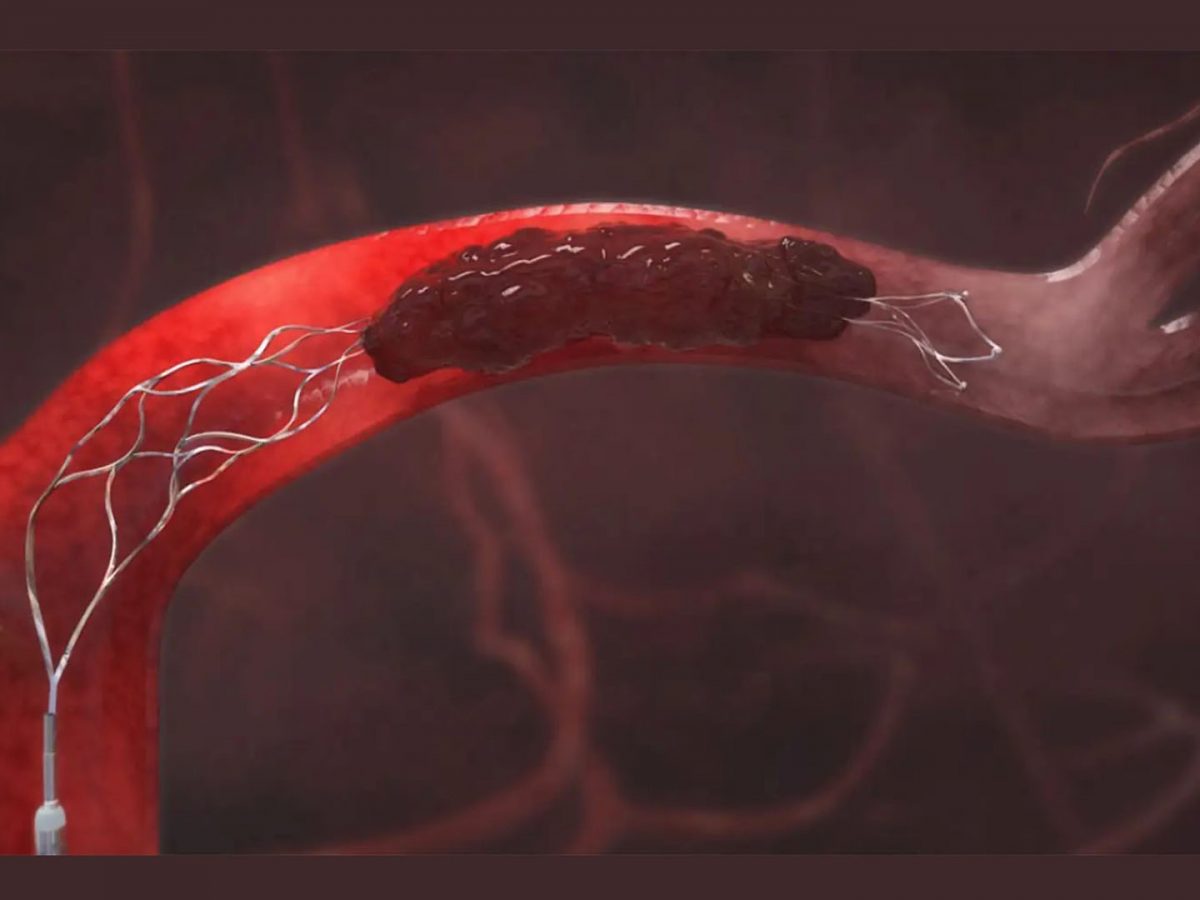 Cardiovascular Systems and Innova Vascular partner on thrombectomy ...