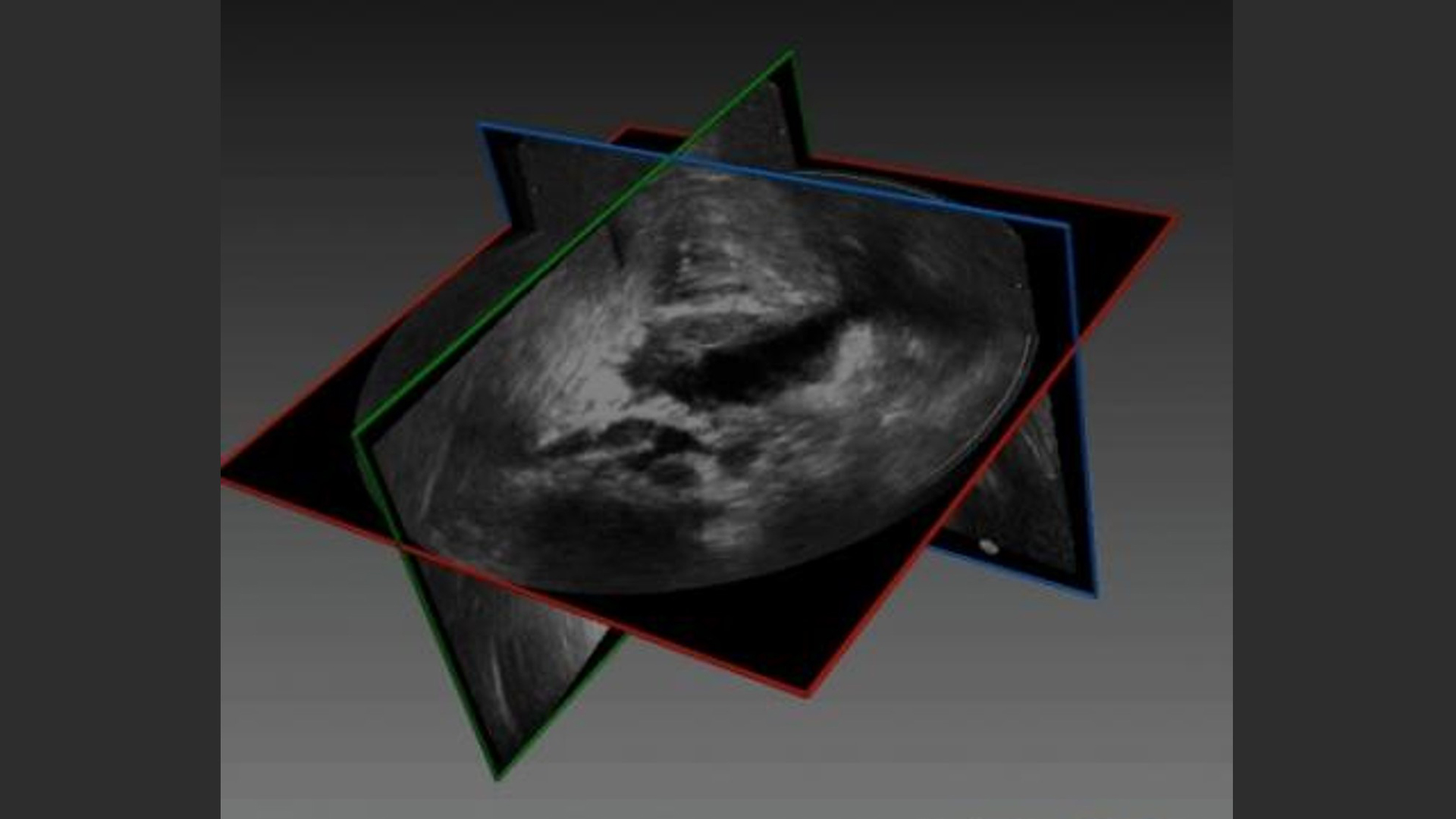 New AI tool for prostate MRI analysis to support PI-RADS scoring ...