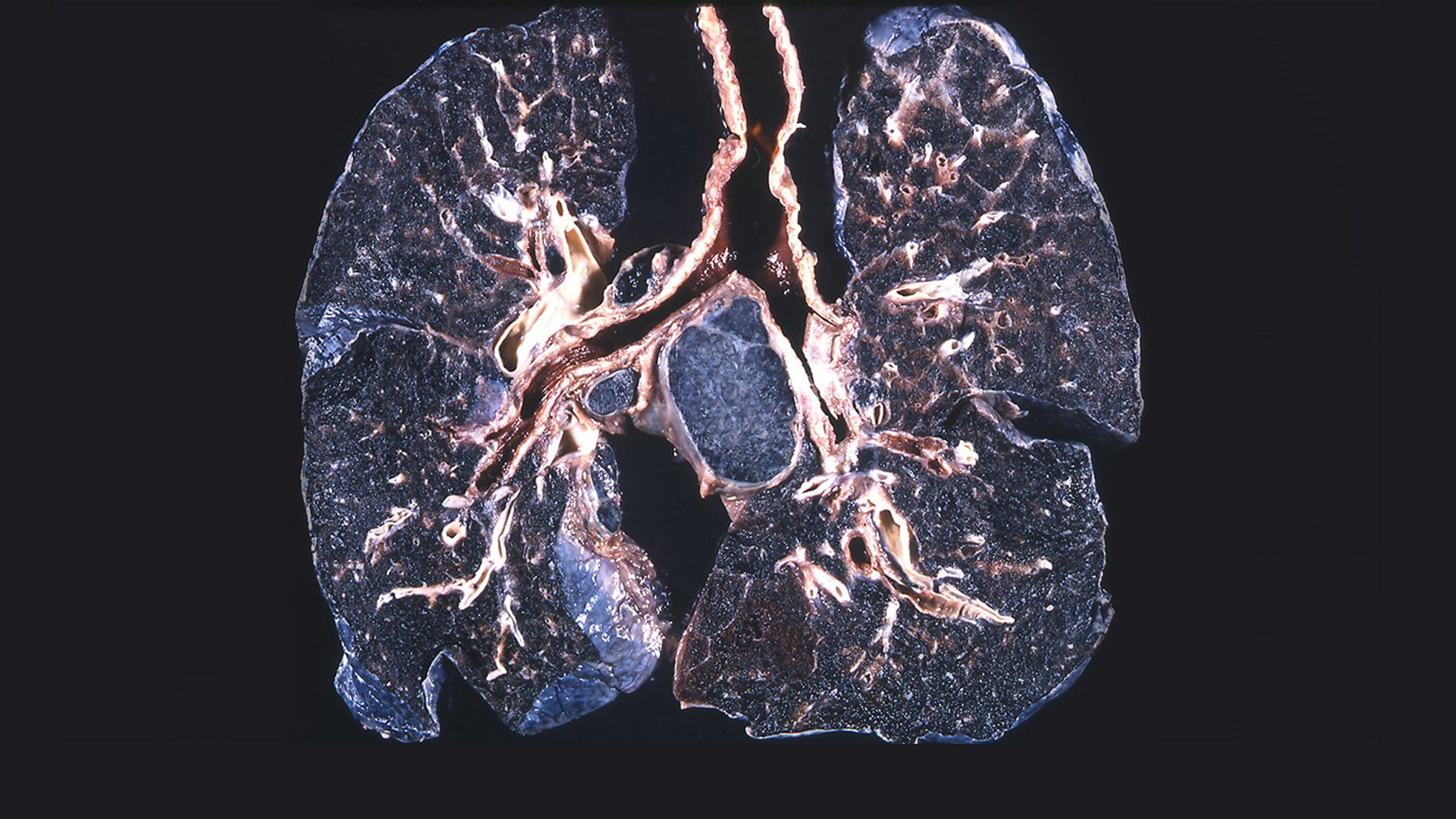 What is causing the rise in black lung disease? - Healthcare Radius