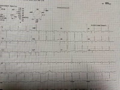 The emergence of Conduction System Pacing – A new age pacemaker ...