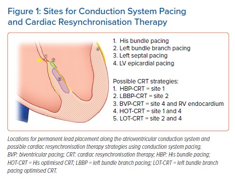 The emergence of Conduction System Pacing – A new age pacemaker ...