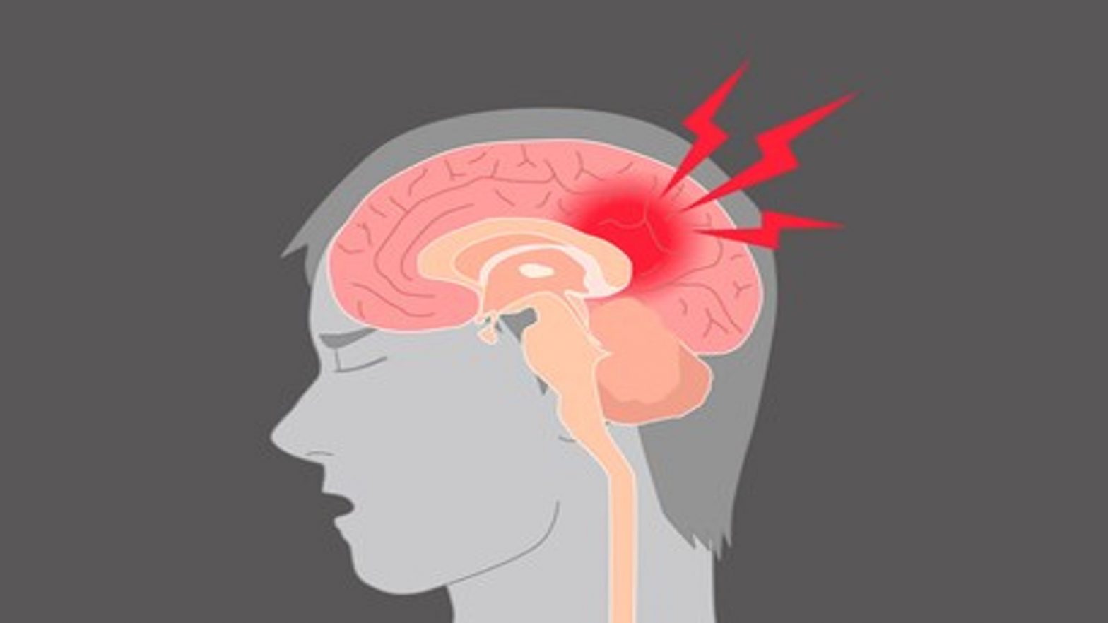 Brain stimulation and Botox: Promising treatment options for Stroke ...