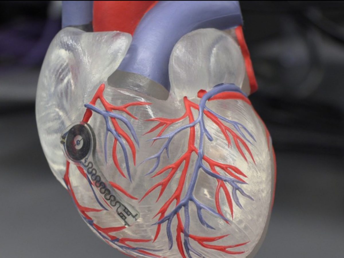Smart, dissolving pacemaker communicates with body-area sensor and ...