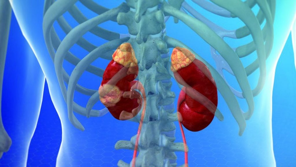 Manage complex kidney cancers with robotic-assisted partial nephrectomy ...