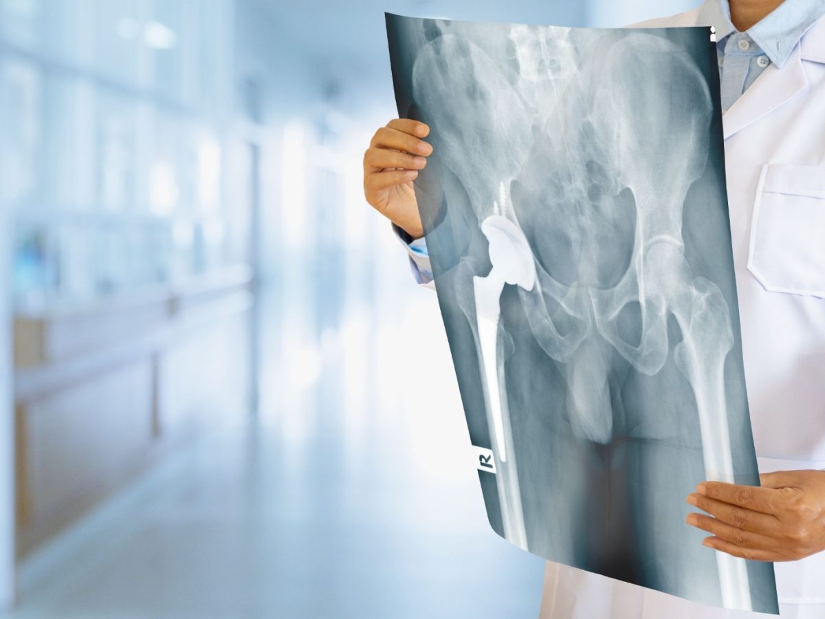 Direct anterior approach for hip replacement surgery - Healthcare Radius Direct anterior approach for hip replacement surgery - Healthcare Radius