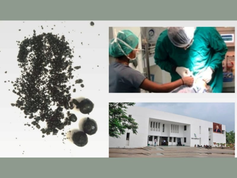 630 gallstones removed from SKD patient at Kaka-Ba Hospital ...