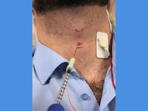 Botox treatment restores falooda vendor's voice - Healthcare Radius