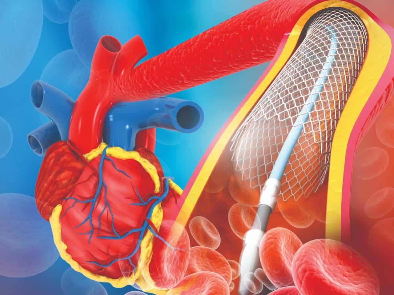 Advancements in coronary artery disease (CAD) treatment - Healthcare Radius