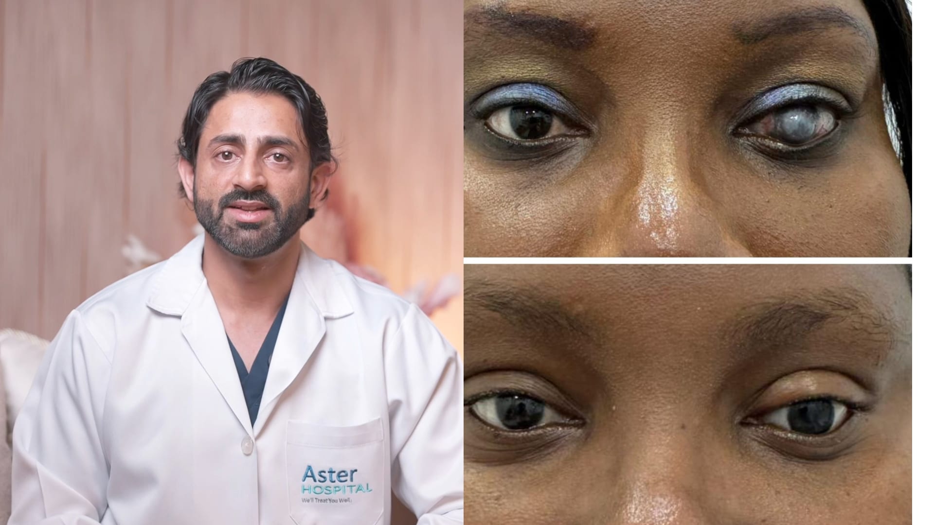 42-year-old undergoes Ocular Prosthesis surgery at Aster Hospital Al Qusais - Healthcare Radius