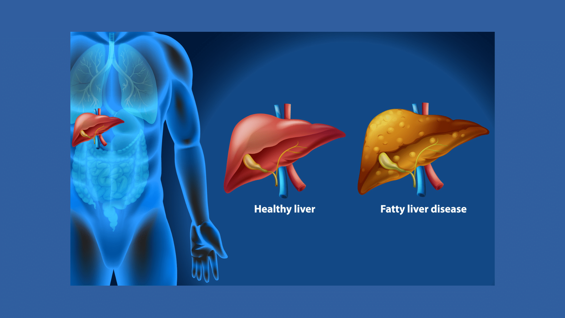 Why fatty liver disease is rising among Indians? - Healthcare Radius