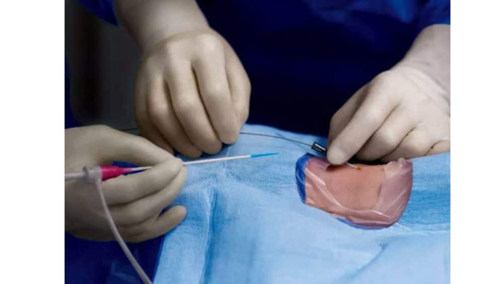 Angioplasty 101: What every patient should know before the procedure ...
