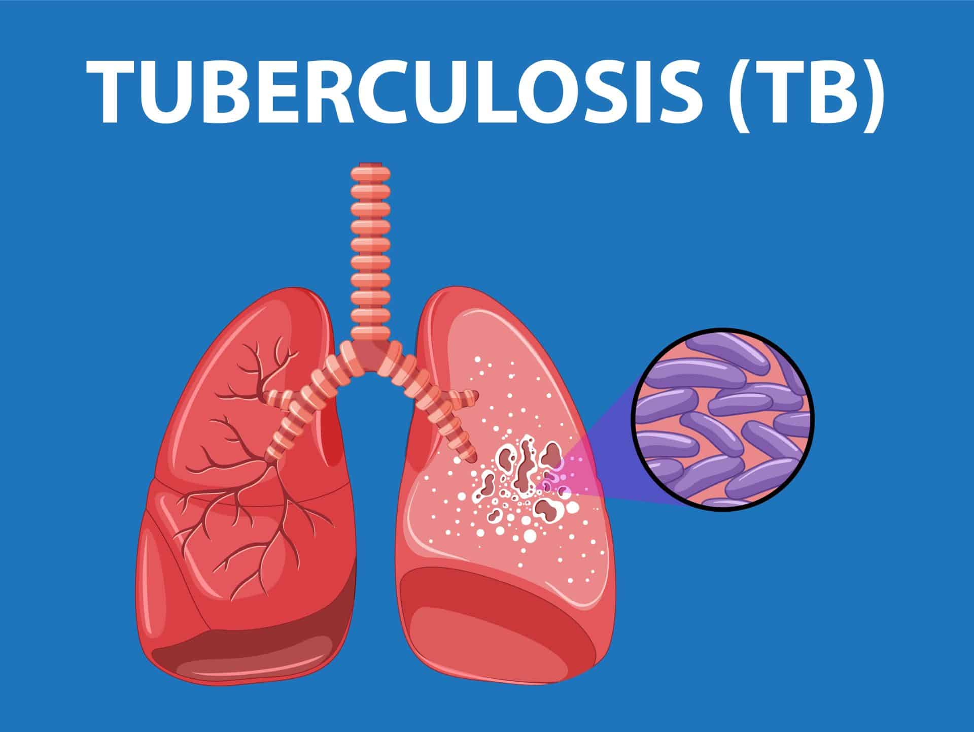 TB Mukt Bharat: Govt launches 826 new lifesaving TB centers